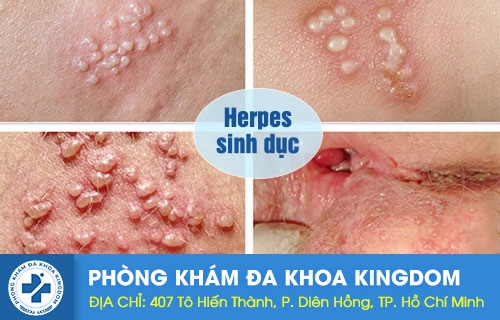 Herpes sinh dục là gì? Dấu hiệu nhận biết, tác hại của bệnh và cách điều trị hiệu quả